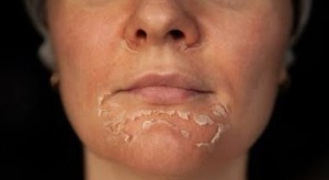 10 facts: Desquamation or Skin peeling, is it a sign of skin healing ...
