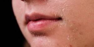 10 facts: Desquamation or Skin peeling, is it a sign of skin healing ...
