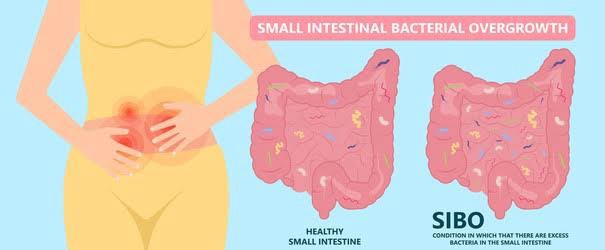 10 facts : What is SIBO or blind loop syndrome ? – 3H:health,happiness ...